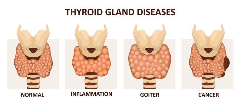Lump In Throat Thyroid