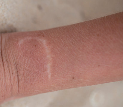 Keroid Bilder – Durchsuchen 5 Archivfotos, Vektorgrafiken und Videos ...