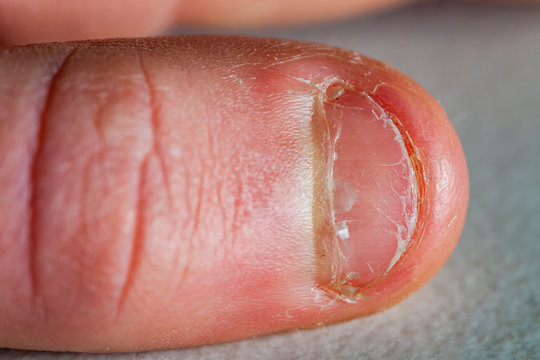 132 BEST Onychophagia IMAGES, STOCK PHOTOS & VECTORS | Adobe Stock