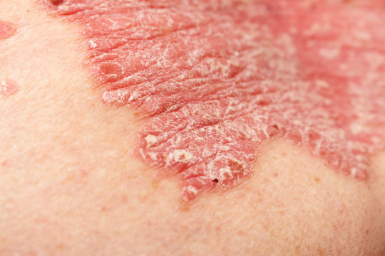 Erythroderma Images – Browse 62 Stock Photos, Vectors, and Video ...