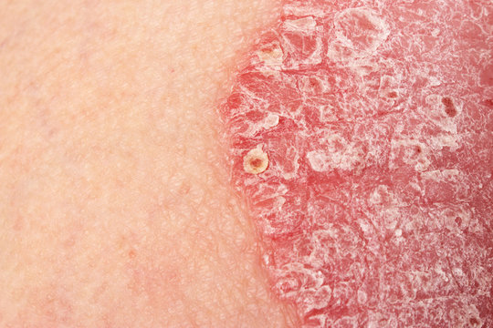 Erythroderma Images – Browse 53 Stock Photos, Vectors, and Video ...