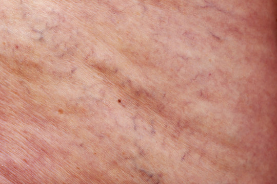 Lipodermatosclerosis Bilder – Durchsuchen 128 Archivfotos ...