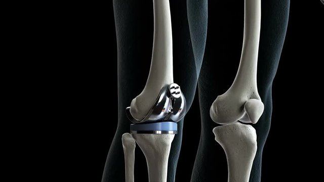 "Knee Replacement" Images – Browse 1,205 Stock Photos, Vectors, and ...