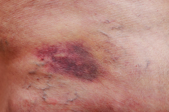 Lipodermatosclerosis Bilder – Durchsuchen 140 Archivfotos ...