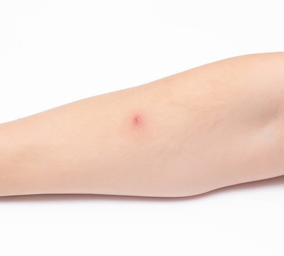 รูปภาพFuruncle – เลือกดูภาพถ่ายสต็อก เวกเตอร์ และวิดีโอ1,046,041 ...