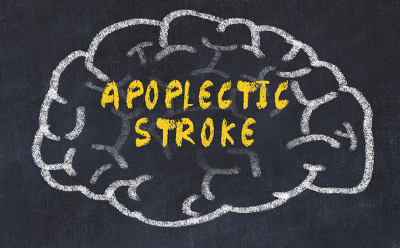 Apoplectic bilder – Bläddra bland 260 stockfoton, vektorer och videor ...