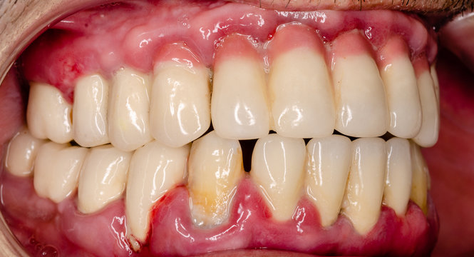 รูปภาพParodontosis – เลือกดูภาพถ่ายสต็อก เวกเตอร์ และวิดีโอ818 | Adobe ...