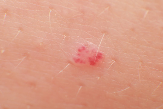 Angioma bilder – Bläddra bland 338 stockfoton, vektorer och videor ...