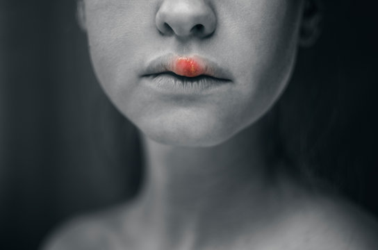 "Blisters Crust" Images – Browse 108 Stock Photos, Vectors, and Video ...