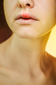 "Blisters Crust" Images – Browse 108 Stock Photos, Vectors, and Video ...