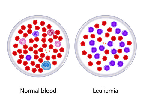 รูปภาพLeukaemia – เลือกดูภาพถ่ายสต็อก เวกเตอร์ และวิดีโอ16,560 | Adobe ...