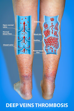 รูปภาพPhlebitis – เลือกดูภาพถ่ายสต็อก เวกเตอร์ และวิดีโอ1,204 | Adobe Stock