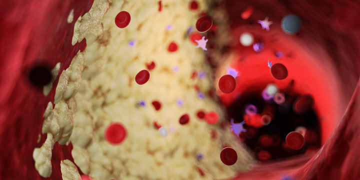 Fibrinbelag-Bilder: Stock-Fotos & -Videos. | Adobe Stock