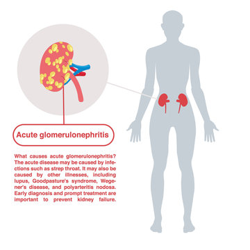 Nephroptosis Images – Parcourir 120 le catalogue de photos, vecteurs et ...