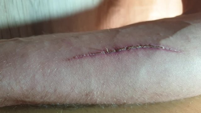 Hand Injury Images – Browse 268,107 Stock Photos, Vectors, and Video ...