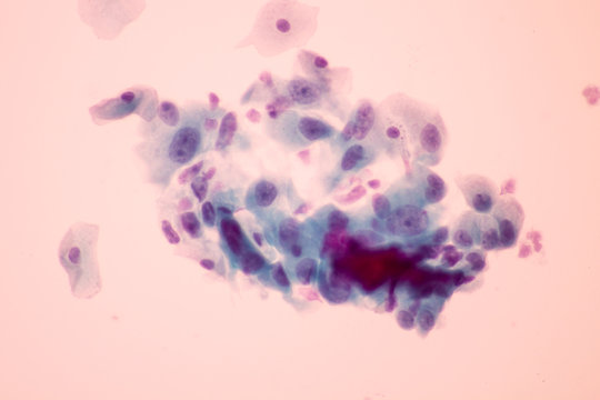 Metaplasia Images – Browse 956 Stock Photos, Vectors, and Video | Adobe ...