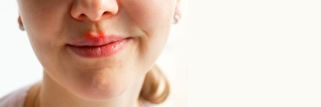 "Blisters Crust" Images – Browse 108 Stock Photos, Vectors, and Video ...