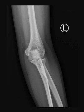 Coronoid Images – Browse 208 Stock Photos, Vectors, and Video | Adobe Stock