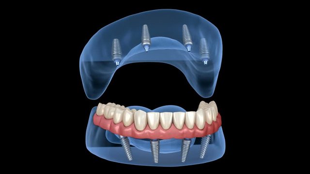Overdenture Images – Browse 925 Stock Photos, Vectors, and Video ...