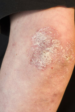 รูปภาพDermatose – เลือกดูภาพถ่ายสต็อก เวกเตอร์ และวิดีโอ132 | Adobe Stock