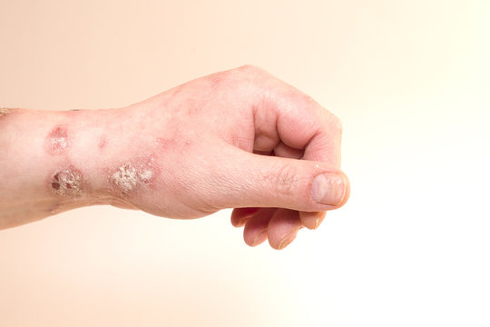 รูปภาพDermatose – เลือกดูภาพถ่ายสต็อก เวกเตอร์ และวิดีโอ132 | Adobe Stock