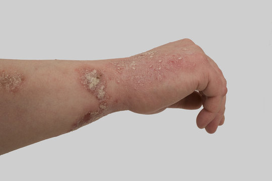 รูปภาพDermatose – เลือกดูภาพถ่ายสต็อก เวกเตอร์ และวิดีโอ132 | Adobe Stock