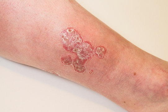 รูปภาพDermatose – เลือกดูภาพถ่ายสต็อก เวกเตอร์ และวิดีโอ132 | Adobe Stock