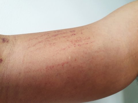 Petechien-Bilder: Stock-Fotos & -Videos. | Adobe Stock