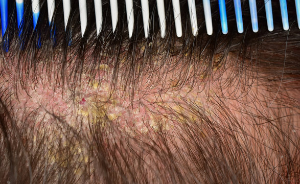 Seborrea Images – Browse 11 Stock Photos, Vectors, and Video | Adobe Stock