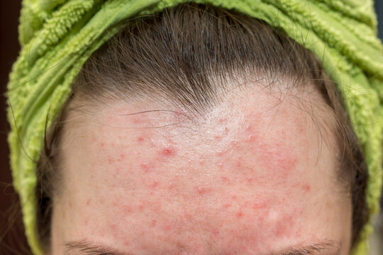 Folliculitis Forehead