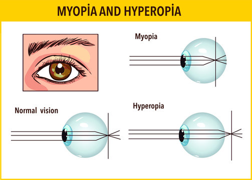 Hyperopia Diagram