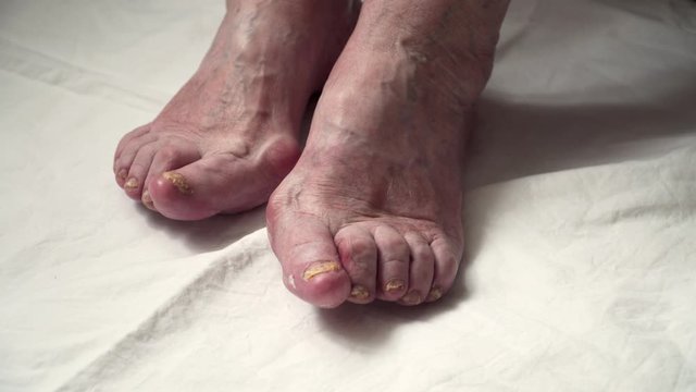 Podagra - Images et vidéos libres de droits | Adobe Stock