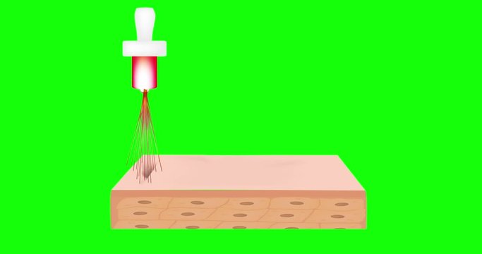 Lasabrasion Images – Browse 7 Stock Photos, Vectors, and Video | Adobe ...