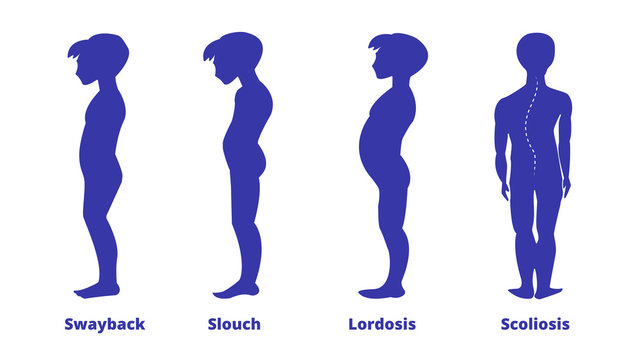 1,143 BEST Lordosis IMAGES, STOCK PHOTOS & VECTORS | Adobe Stock