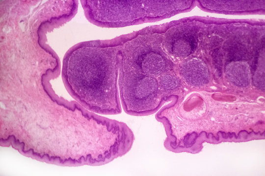 Gaumenmandeln Bilder – Durchsuchen 272 Archivfotos, Vektorgrafiken und ...