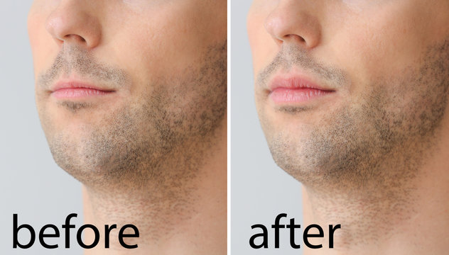 「Cheiloplasty」の画像 - 159 件の Stock 写真、ベクターおよびビデオ | Adobe Stock