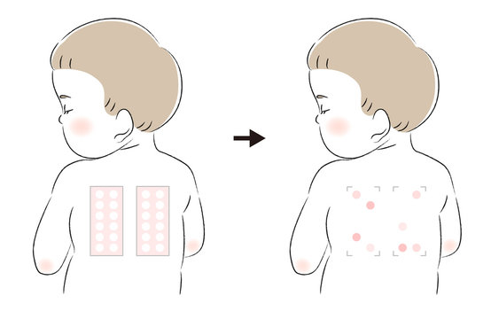 Epikutantest Bilder – Durchsuchen 140 Archivfotos, Vektorgrafiken und ...