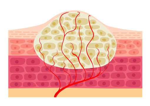 Angioma Bilder – Durchsuchen 439 Archivfotos, Vektorgrafiken und Videos ...