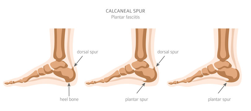 Plantar Calcaneal Enthesophyte