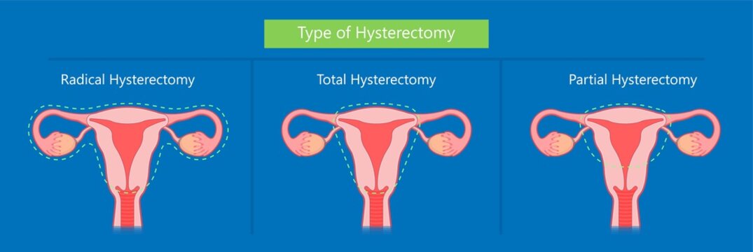 รูปภาพMyomectomy – เลือกดูภาพถ่ายสต็อก เวกเตอร์ และวิดีโอ123 | Adobe Stock