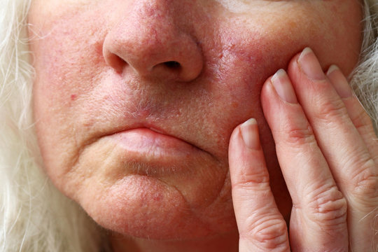 Basaliom-Bilder: Stock-Fotos & -Videos. | Adobe Stock