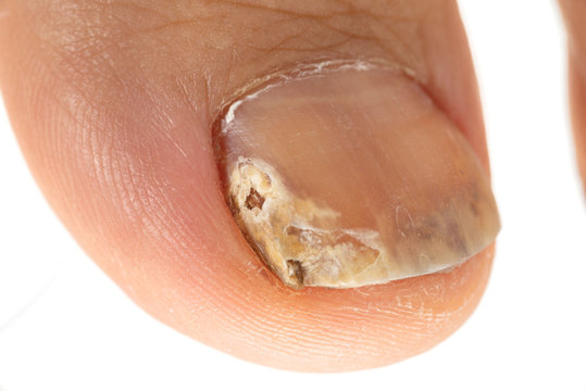 รูปภาพDermatophytosis – เลือกดูภาพถ่ายสต็อก เวกเตอร์ และวิดีโอ8,199 ...