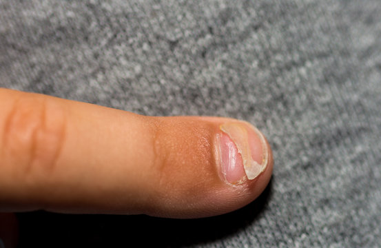 9 BEST Hand-Foot-Mouth IMAGES, STOCK PHOTOS & VECTORS | Adobe Stock