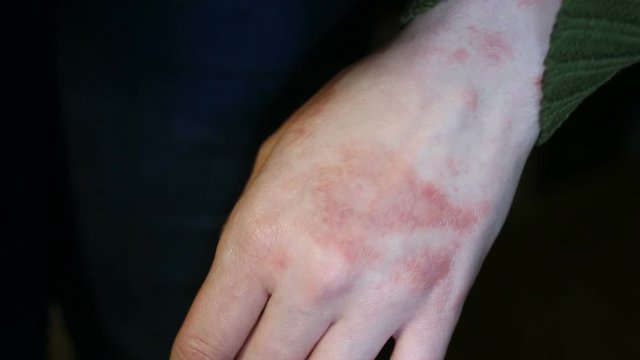 Neurodermatitis Images – Parcourir 520 le catalogue de photos, vecteurs ...