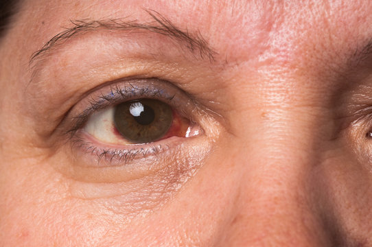 Bindehautsack Bilder – Durchsuchen 1,582 Archivfotos, Vektorgrafiken ...