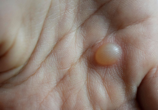 "Water Blister" Images – Browse 106 Stock Photos, Vectors, and Video ...