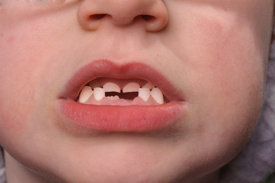 Milchgebiss Imagens – Procure 63 fotos, vetores e vídeos | Adobe Stock