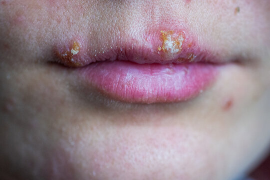 Labial-Is 影像 – 瀏覽 42 個素材庫相片、向量圖和影片 | Adobe Stock