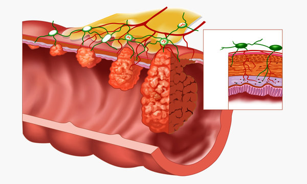 รูปภาพMetastasis – เลือกดูภาพถ่ายสต็อก เวกเตอร์ และวิดีโอ7,497 | Adobe ...