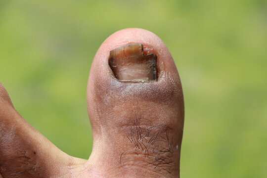 48 BEST Panaritium IMAGES, STOCK PHOTOS & VECTORS | Adobe Stock